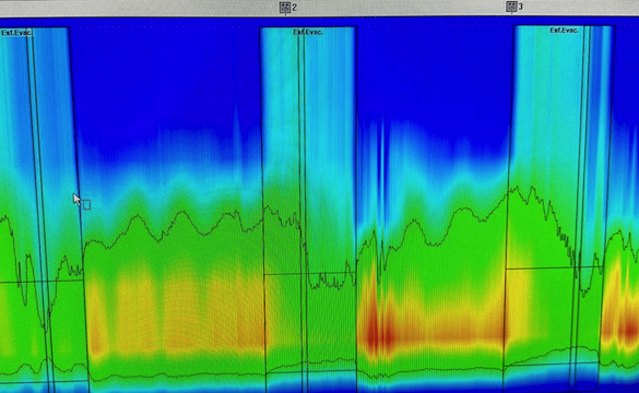 Management of Gallbladder Polyps: When to Follow Up and When to ...