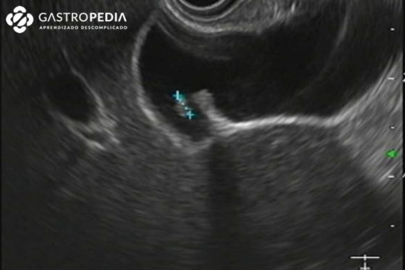 Anorectal Manometry: concepts, indications, and technique - Gastropedia