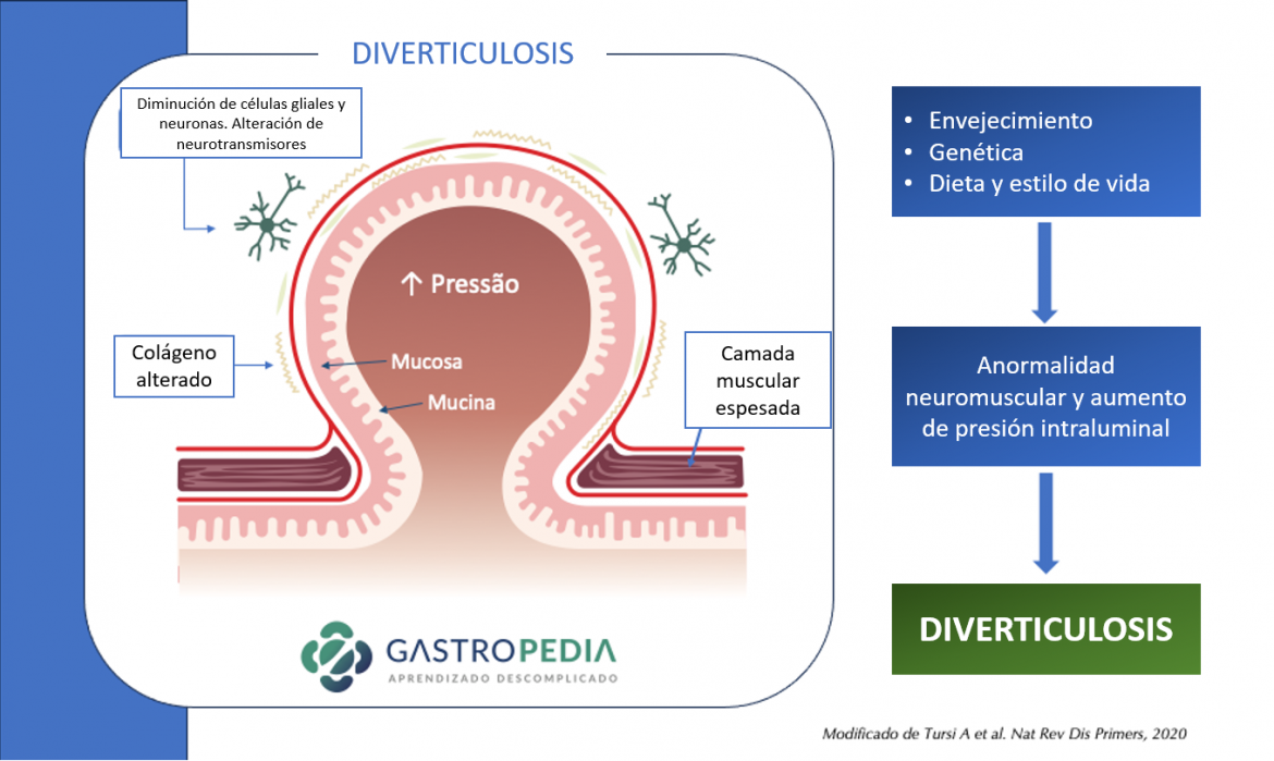 Enfermedad diverticular del colon: epidemiología y fisiopatología ...