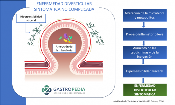 Enfermedad diverticular del colon: epidemiología y fisiopatología ...