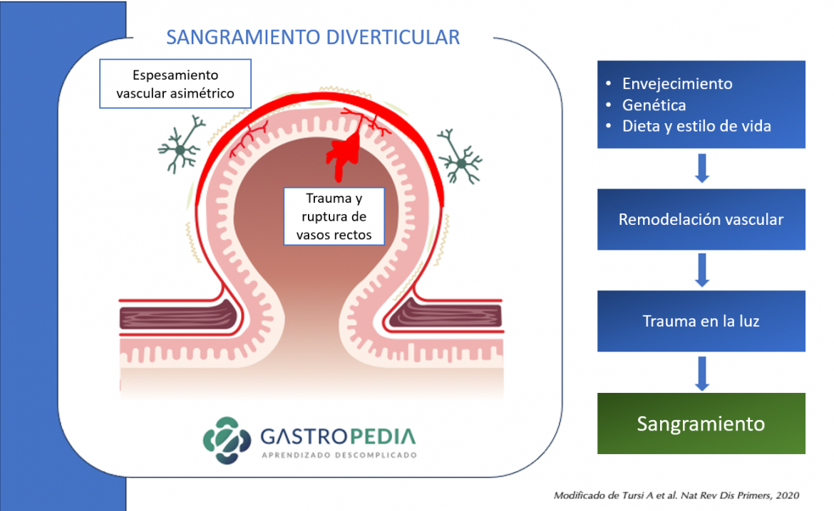 Enfermedad diverticular del colon: epidemiología y fisiopatología ...
