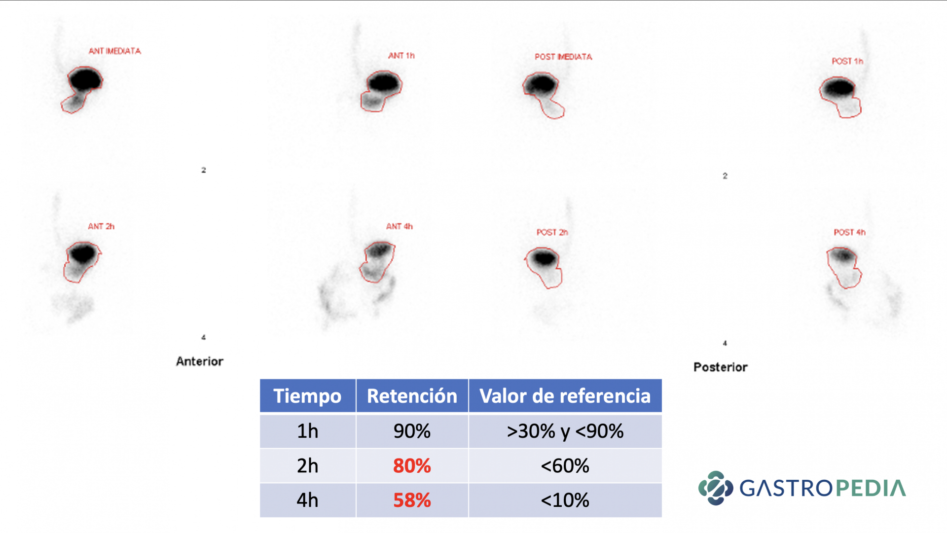 Gastroparesia: ¿cuándo pensar, por qué ocurre y cómo diagnosticar ...