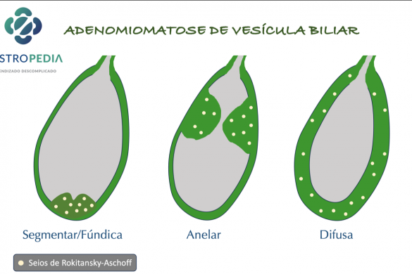 Manometría Anorrectal: conceptos, indicaciones y técnica - Gastropedia