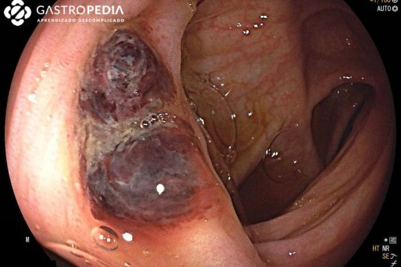 Enfermedad diverticular del colon: epidemiología y fisiopatología ...