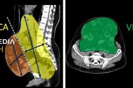 Síndrome de Dumping - Gastropedia