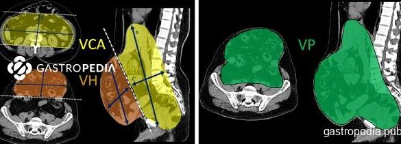 Síndrome de Dumping - Gastropedia