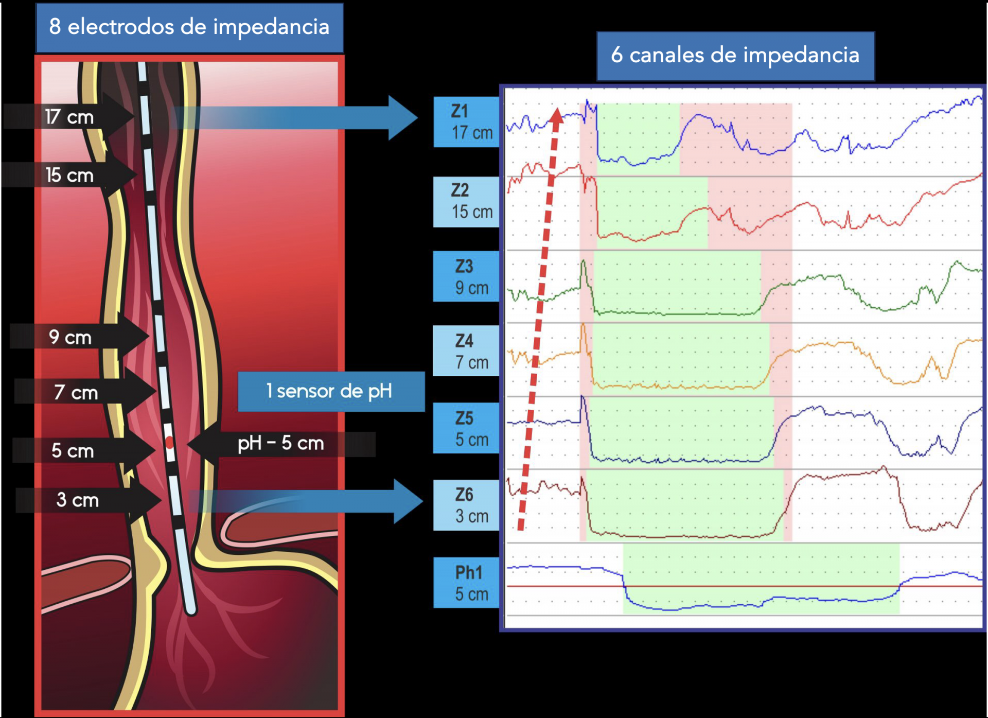 Impedancio-pHmetría esofágica: Principios técnicos - Gastropedia