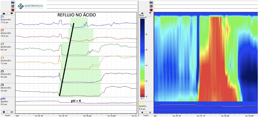 Impedancio-pHmetría esofágica: Principios técnicos - Gastropedia