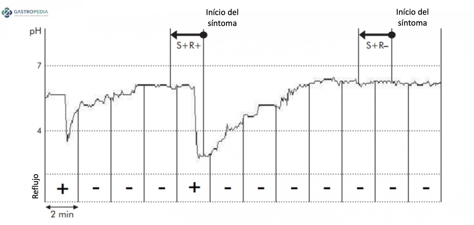 Impedancio-pHmetría esofágica: Principios técnicos - Gastropedia