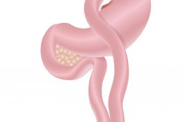 Adenomiomatosis de la Vesícula Biliar - Gastropedia