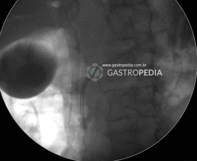 Pancreatite Autoimune - Gastropedia