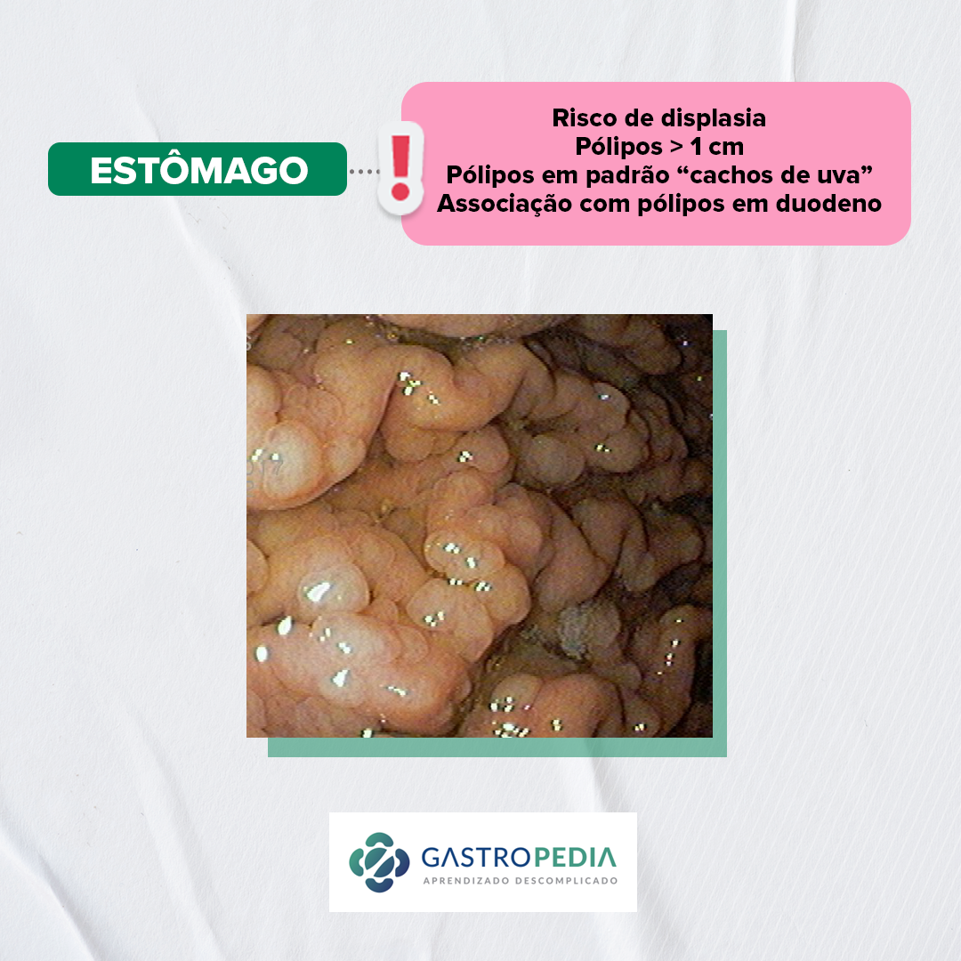 ESTÔMAGO E DUODENO NAS SÍNDROMES DE POLIPOSE - Gastropedia