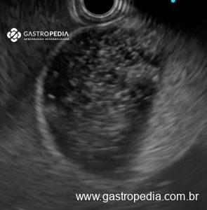 Microcálculos e barro biliar – Quais seus valores para a prática ...