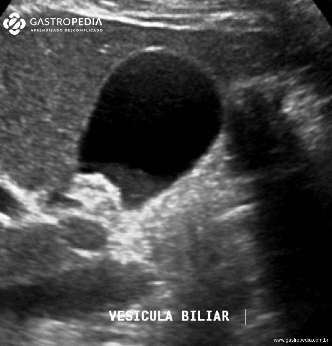 Microcálculos e barro biliar – Quais seus valores para a prática ...