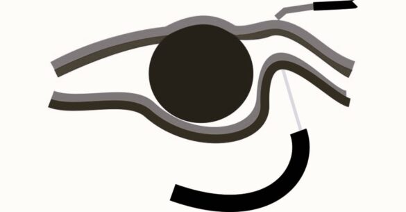 Técnicas combinadas para ressecção localizada de espessura total da ...