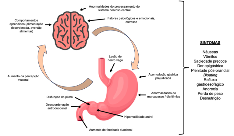 Gastroparesia: quando pensar, por que ocorre e como diagnosticar ...