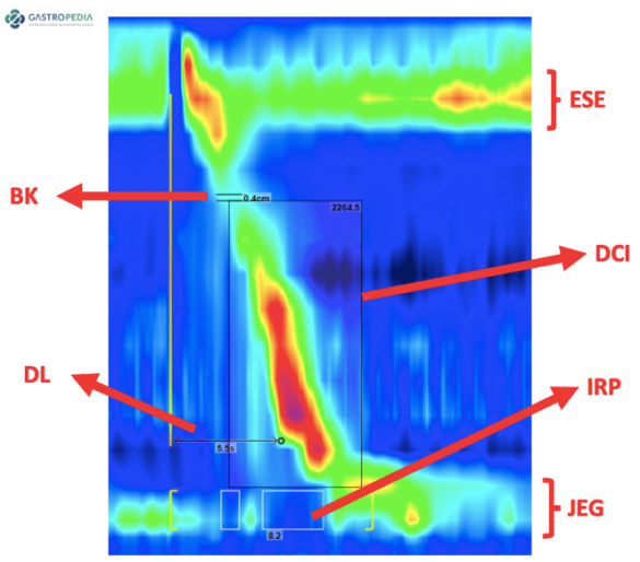 O que você precisa saber sobre Espasmo Esofágico Distal - Gastropedia