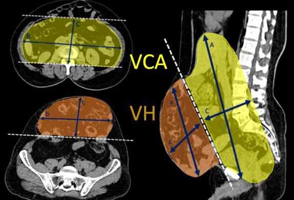 Cirurgia cooperativa laparoscópica e endoscópica (LECS) para ressecção ...