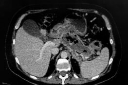 Procinéticos: Mecanismo de Ação, Indicações e Segurança - Gastropedia